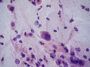 Atypical Glandular Cells Of Undetermined Significance AGUS Download Scientific Diagram