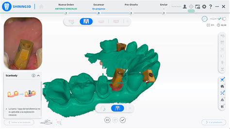 Complete Digital Workflow For Full Oral Rehabilitation With Implants And Veneers