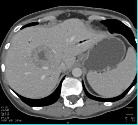 Cholangiocarcinoma With Stent Liver Radiology Case Studies Ctisus Cholangiocarcinoma With Stent Liver Radiology Case Studies Ctisus