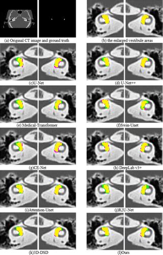 Deeply Supervised Vestibule Segmentation Network For Ct Images With Global Context‐aware Pyramid