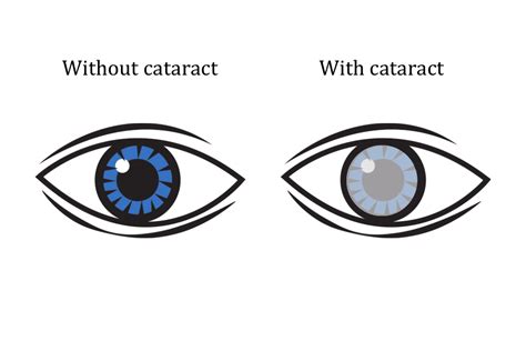 Understanding Cataracts Adelaide City Optometrist