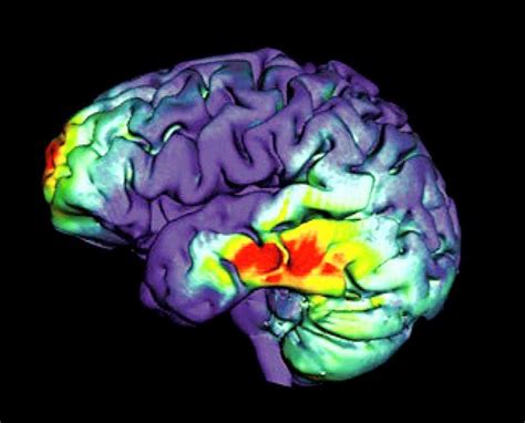 What Is The Importance Of Gadolinium Observed In The Brain On Mri