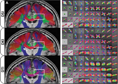 Current State Of Diffusion Weighted Imaging And Diffusion Tensor Imaging For Traumatic Brain