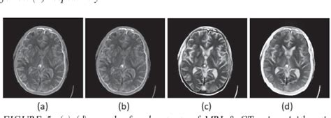 Figure 1 From Mri Ct Fusion Based On Phase Congruency Of Intrinsic
