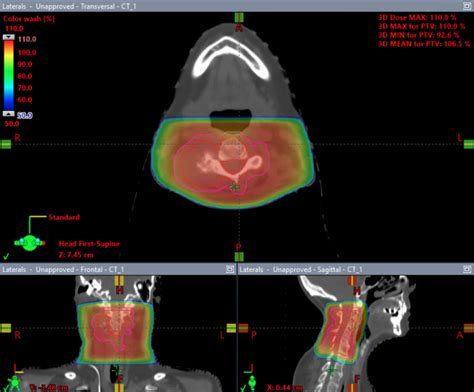 3d Eclipse C Spine Planning Mds School