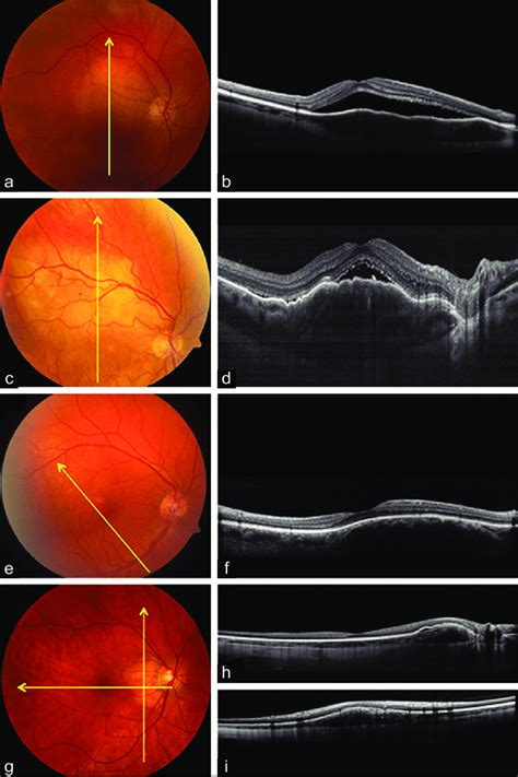 Choroidal Tumors Nonpigmented A And B Choroidal Metastasis From