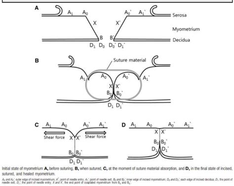 Cesarean Section Technique With Diagram