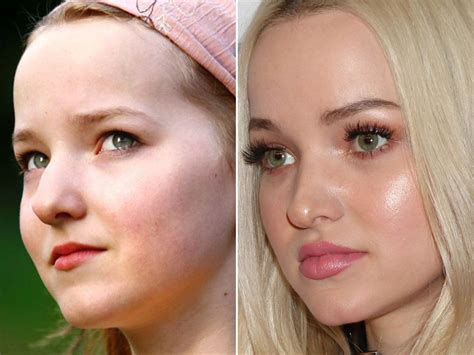 Dove Cameron Before And After From 2008 To 2024 Dove Cameron Lips
