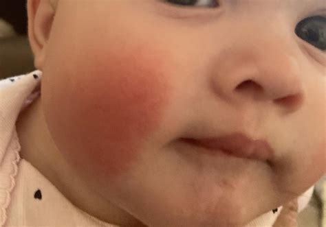 Teething Rash Rmommit