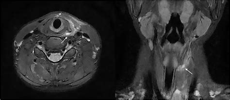 Pyriform Sinus Fistula