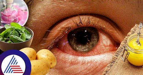 ಕಣ್ಣಿನ ಸೋಂಕಿಗೆ ಮನೆ ಮದ್ದು ಅನಾರೋಗ್ಯಕ್ಕೆ ಹೇಳಿ ಗುಡ್ ಬೈ