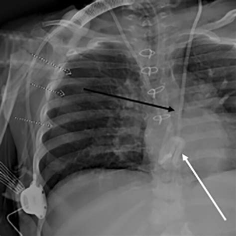 Intraoperative Photos Of A Pericardial Window With A Bactiseal Catheter