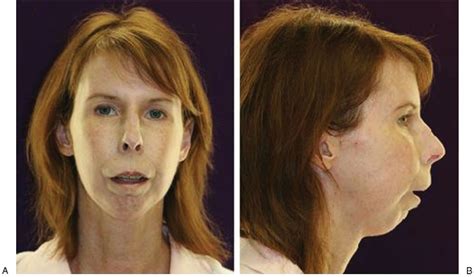 Bilateral Mandibular Condylysis From Systemic Sclerosis Case Report Of