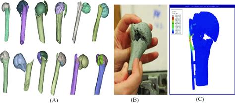 Proximal Humerus Fracture Fixation Models Derived From Patient CT Download Scientific Diagram
