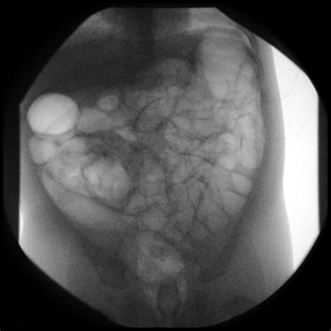 Intussusception Barium Enema Claw Sign