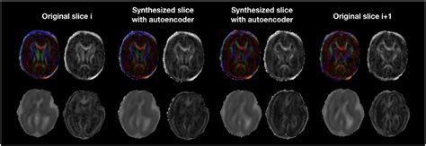 Frontiers Through Plane Super Resolution With Autoencoders In Diffusion Magnetic Resonance