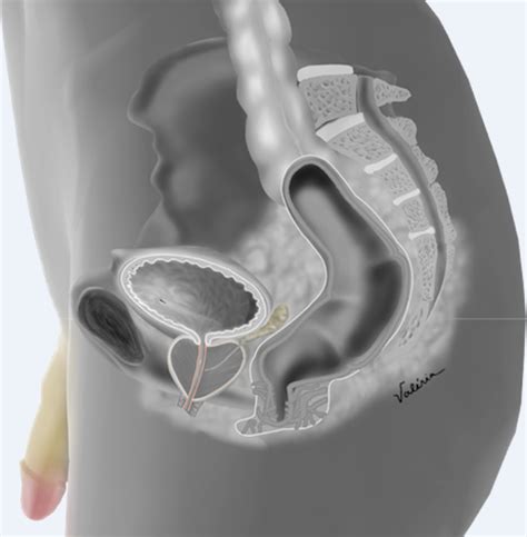 Prostatic Artery Embolization Indications Preparation Techniques