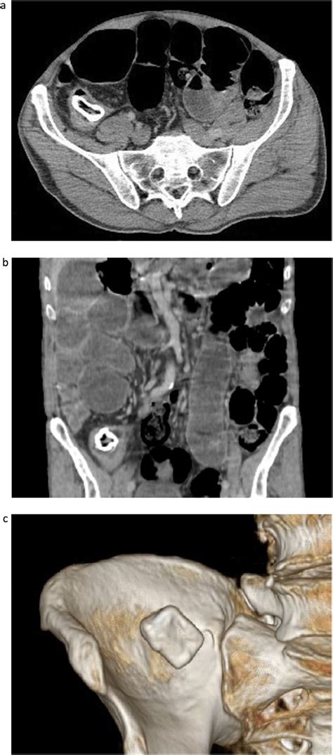 Primary True Enterolithiasis A Rare Cause Of Acute Small Bowel Obstruction Pmc