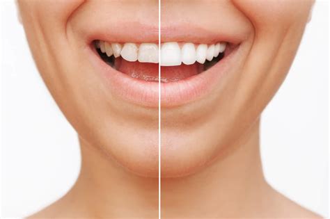 Best Types Of Dental Veneers HKS Dental Office Chula Vista