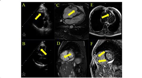 Tte And Cmr Of Emf A 2d Tte Rv Apical Four Chamber Modified View Download Scientific Diagram