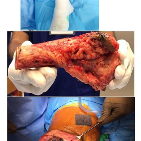 Giant Cell Tumor Of Proximal Tibia After Wide Margin Excision And