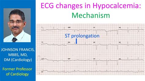 Hypocalcemia Ekg