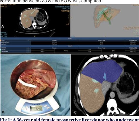 Figure 1 From Comparison Of Semi Automated Ct Volumetry And Intraoperative Graft Weight In