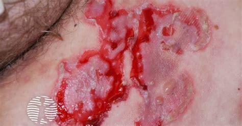 Pemphigus Vulgaris Image