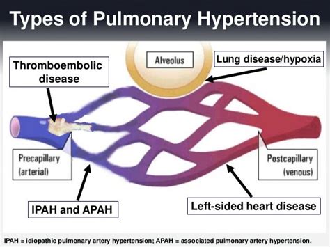Pulmonary Arterial Hypertension In Rural Communities Early Diagnosis…