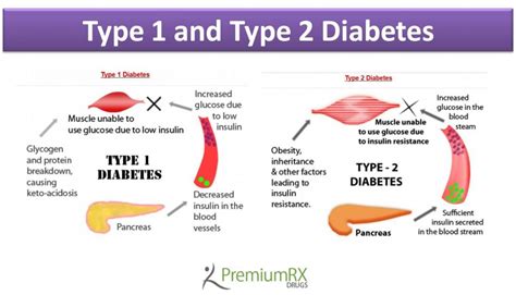 Differences Between Type 1 And Type 2 Mhim
