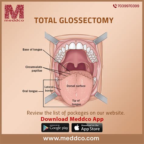Why Is Glossectomy Performed