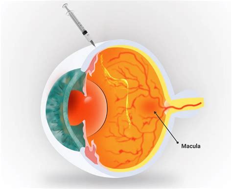 Intravitreal Injections — Dr James English • Ophthalmologist And Ophthalmic Surgeon • Brisbane Qld