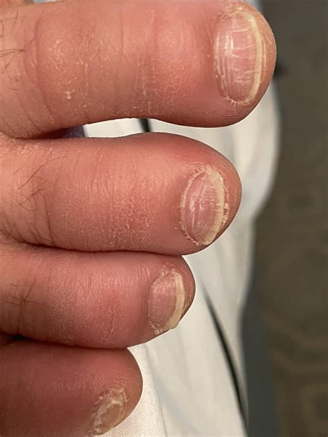 Is This Nail Fungus Picture Rnailfungus