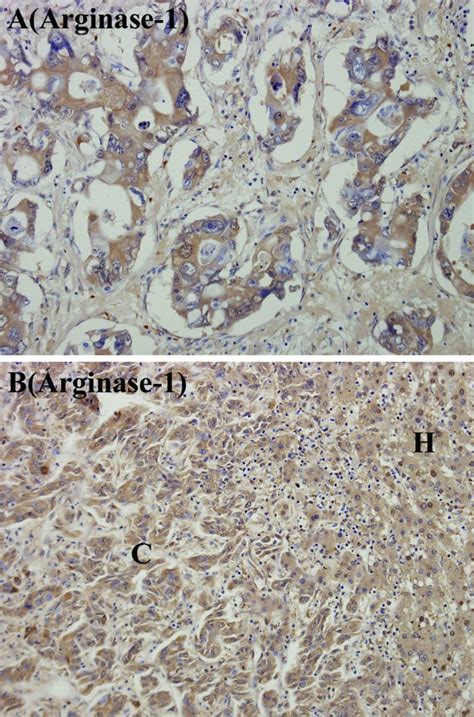 Expression Of Hepatocyte Markers In Mass Forming Peripheral And Periductal Infiltrating Hilar