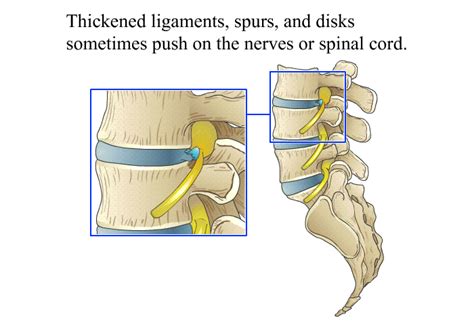 Lumbar Laminectomy And Possible Disk Excision