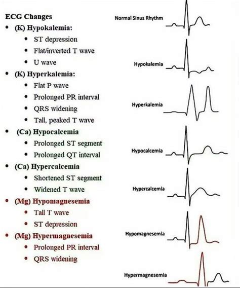 Hyperkalemia Ecg