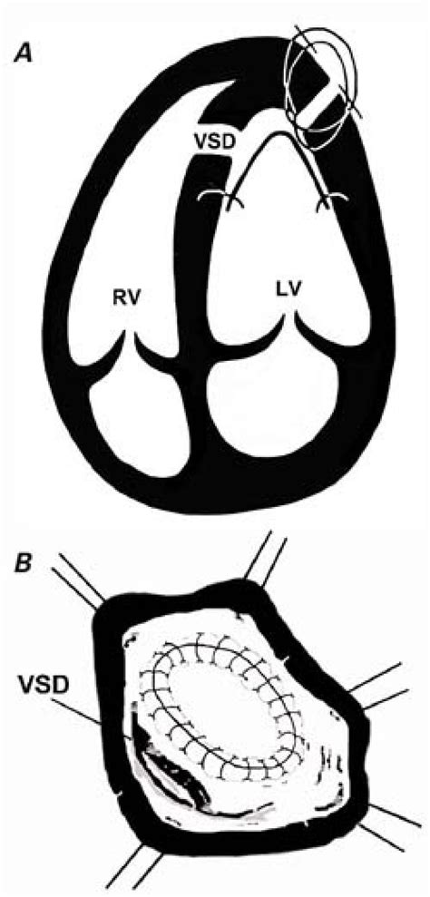 A Modified Infarct Exclusion Technique For Repair Of Anteroapical Postinfarction Ventricular