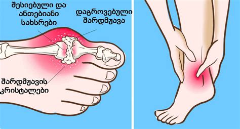 შარდმჟავა პოდაგრას „პატიჟებს“ როგორ გამოვდევნოთ ორგანიზმიდან რჩევები