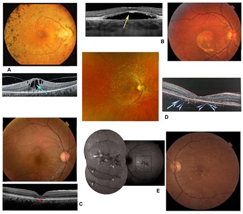 State Of The Art On Inherited Retinal Dystrophies Management And