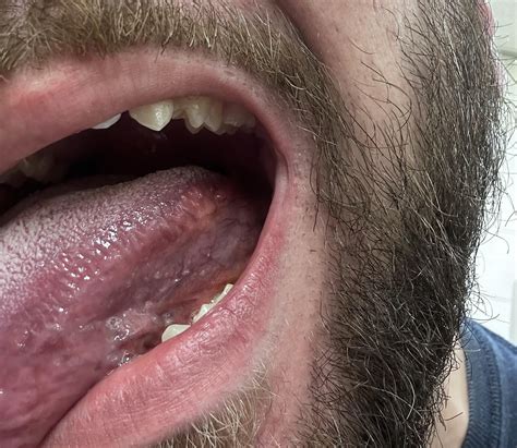 Hairy Leukoplakia Raskdentists