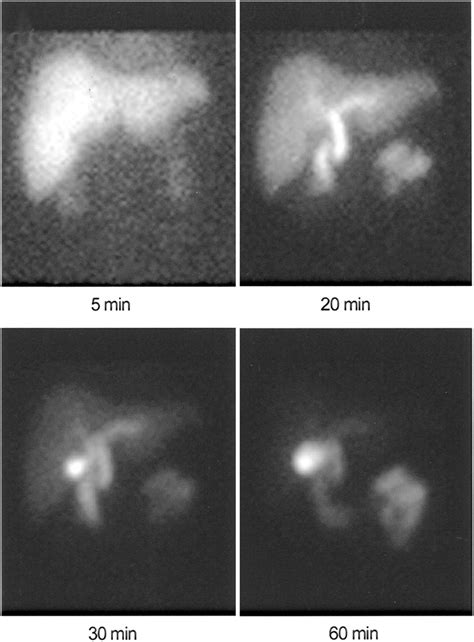 Abnormal Gallbladder Hida Scan Results