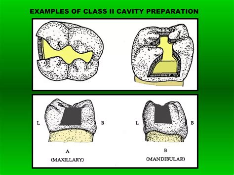 Class Ii Amalgam Preparation Ppt