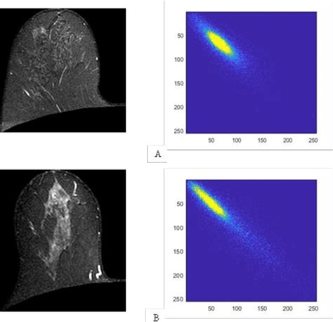 A Normal Mri Breast Slice And Associated Glcm Matrix With θ 0 O And