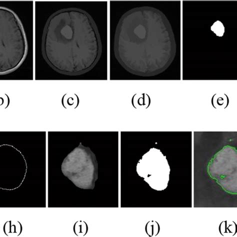 Experimental Result For Meningioma Type Tumor Segmentation A Input Download Scientific