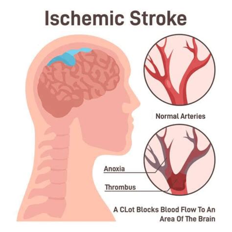 Ischemic Vs Hemorrhagic Stroke Understanding The Difference Supreme
