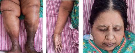 Dermatologic Emergencies Case Series Successful Management Of Ten And Dress Syndrome