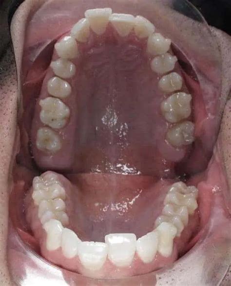 Invisalign Treatment 17 Month Progress Report