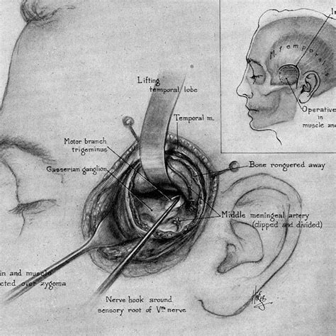 History Of Trigeminal Neuralgia Sources Neurosurgery The Download Scientific