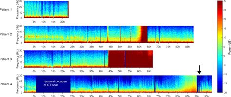 eeg spectrograms of each patient db from − 20 to 30 0 db 1 µv² hz