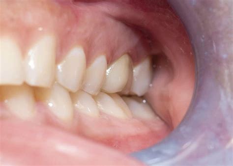 How Does Invisalign Work Blogs WebDental LLC